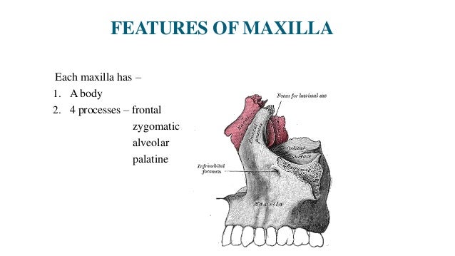 Fracture maxilla
