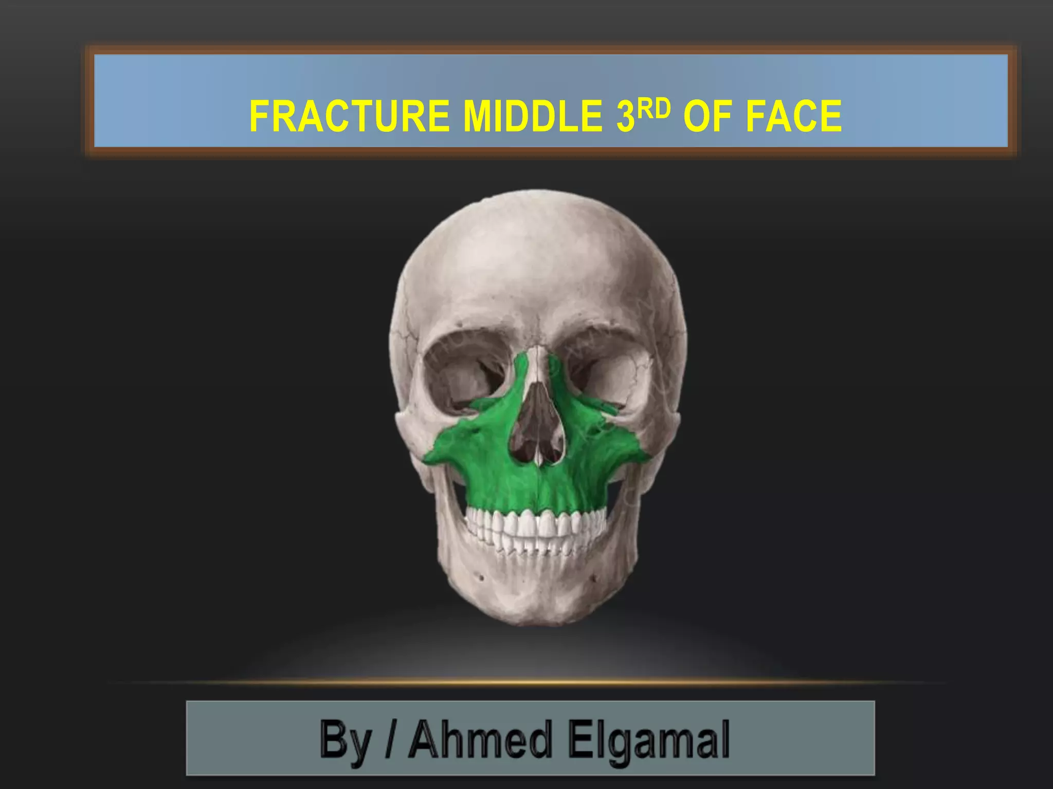 Mid facial fractures ( Mid facial trauma ) | PPTX