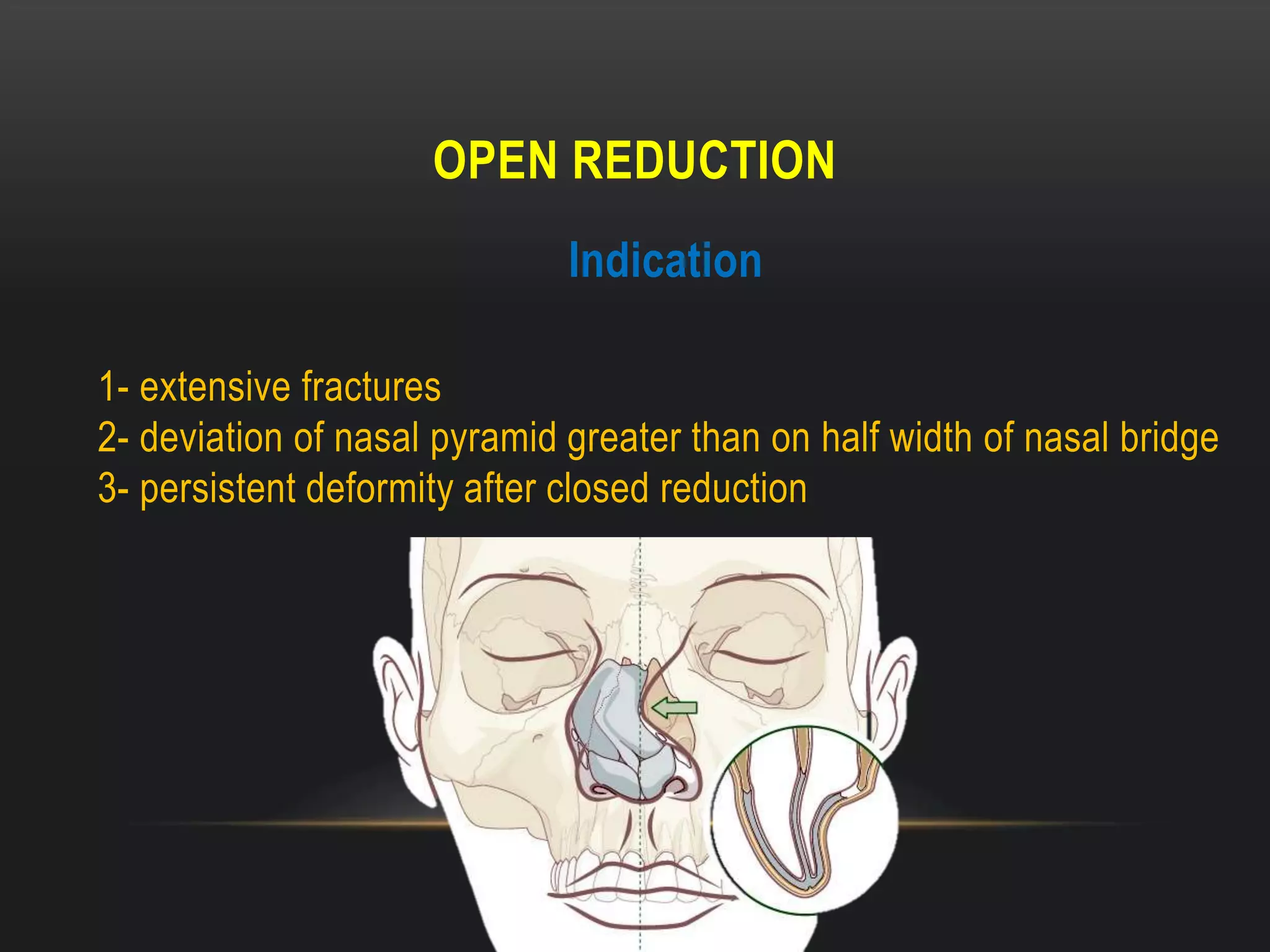Mid facial fractures ( Mid facial trauma ) | PPTX