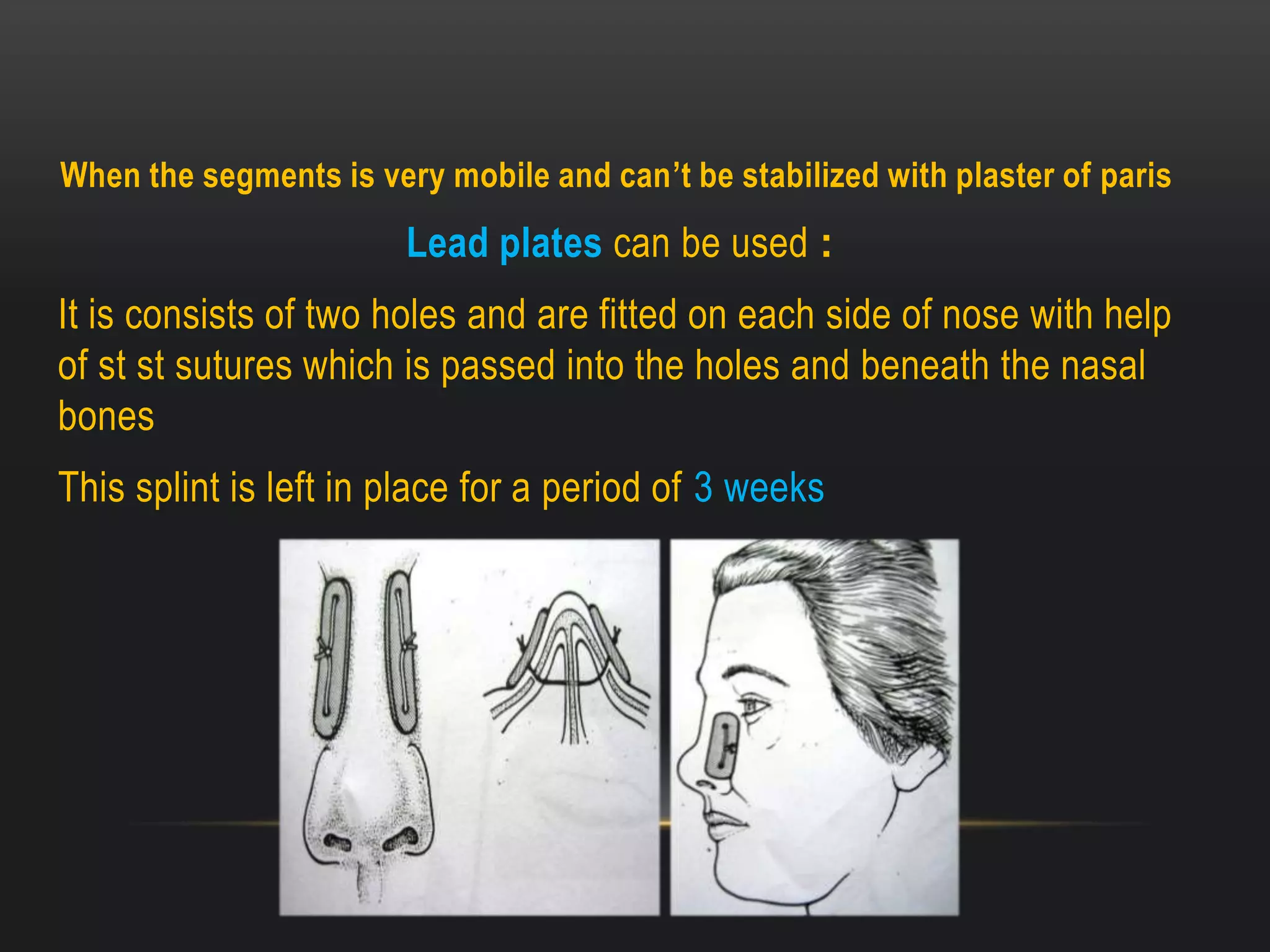 Mid facial fractures ( Mid facial trauma ) | PPTX