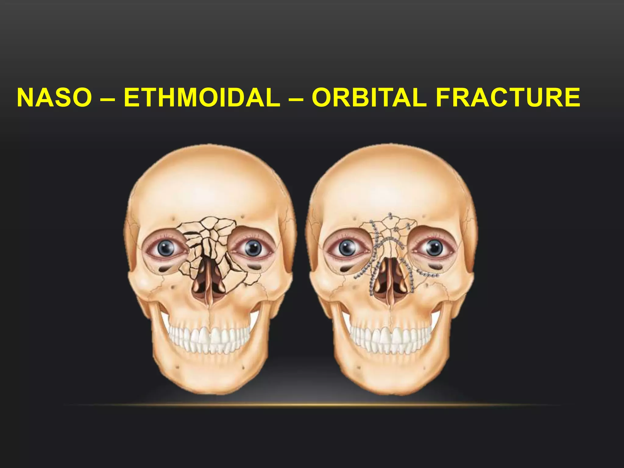 Mid facial fractures ( Mid facial trauma ) | PPTX