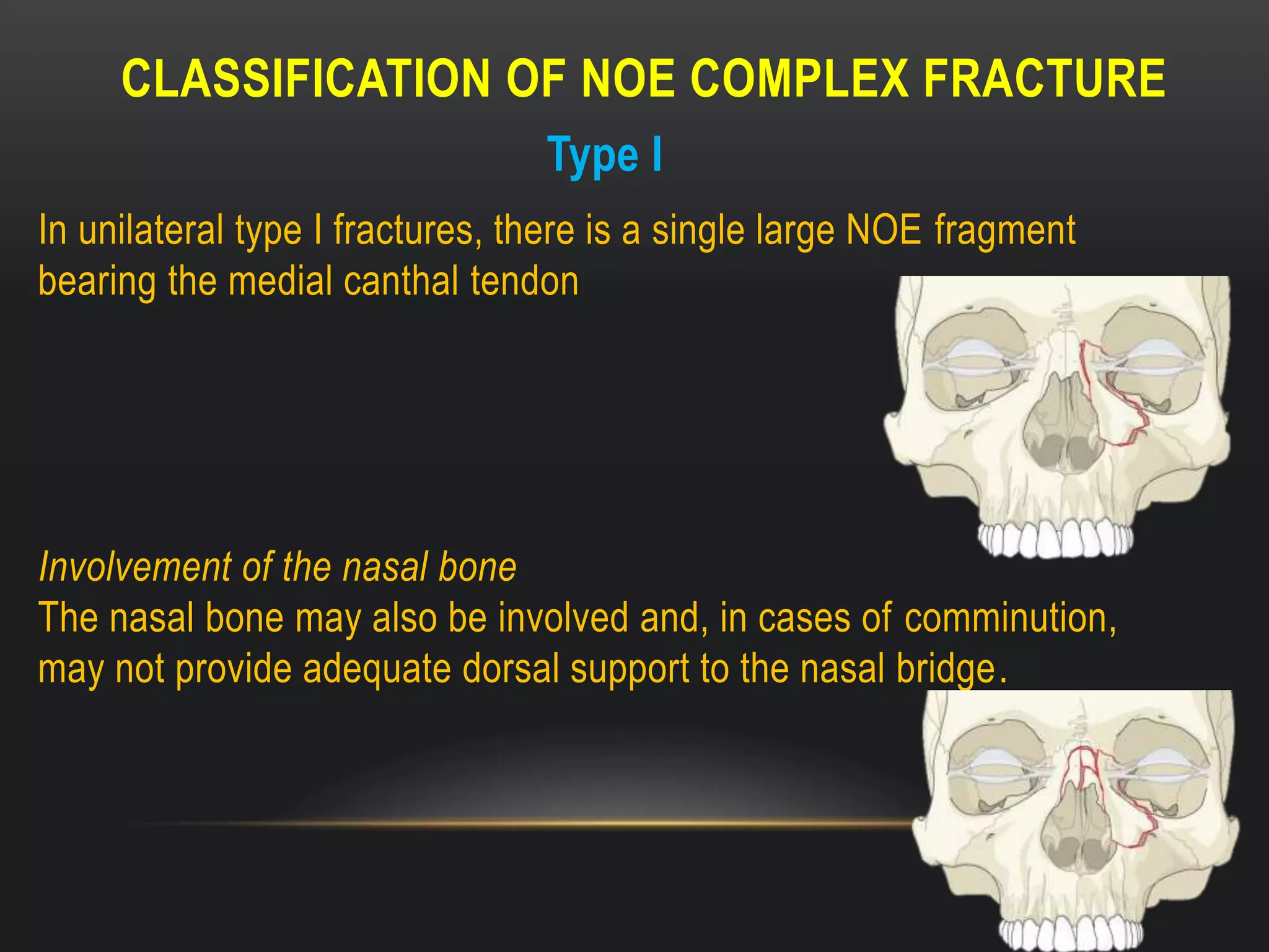 Mid facial fractures ( Mid facial trauma ) | PPTX