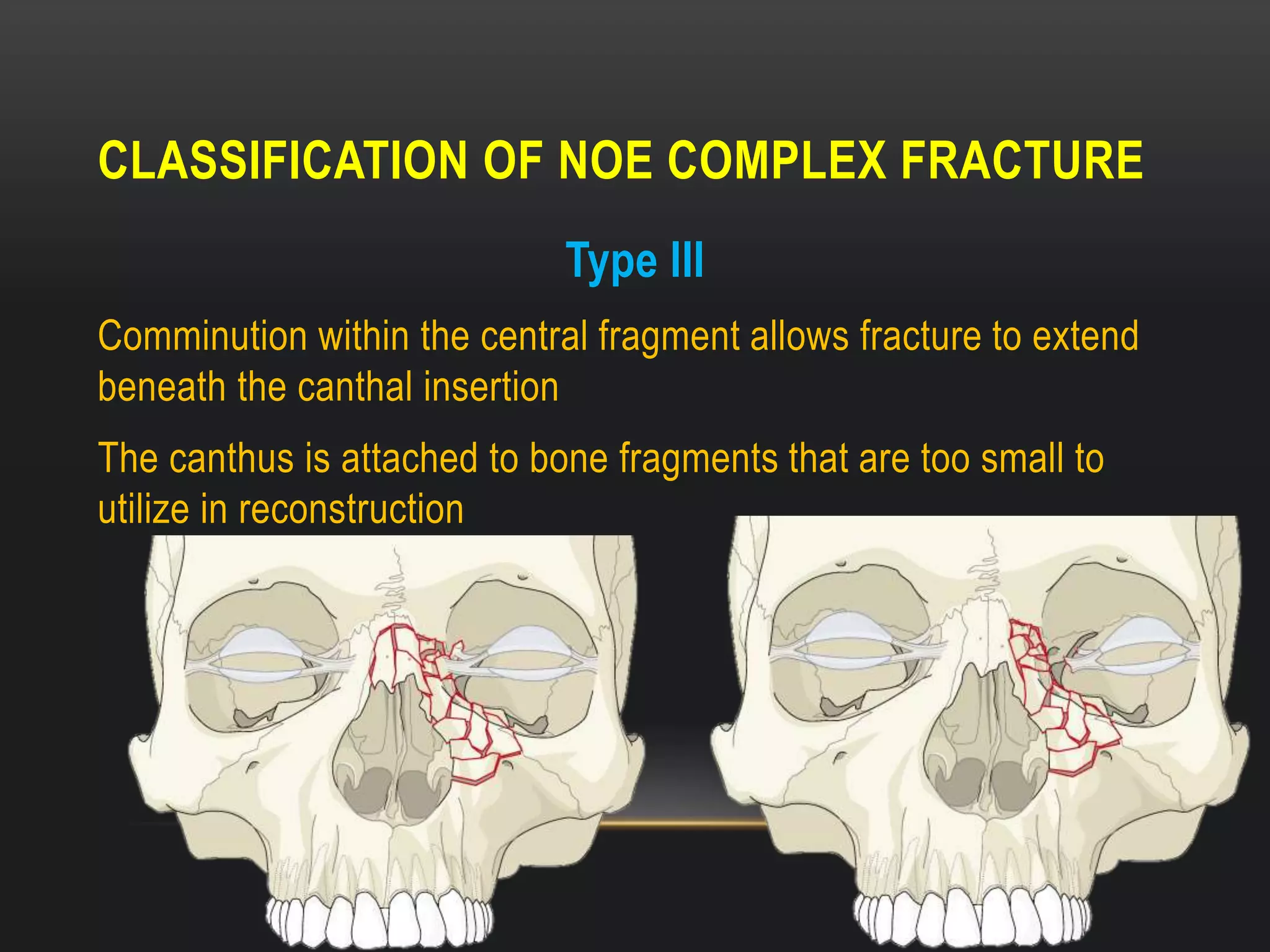 Mid facial fractures ( Mid facial trauma ) | PPTX