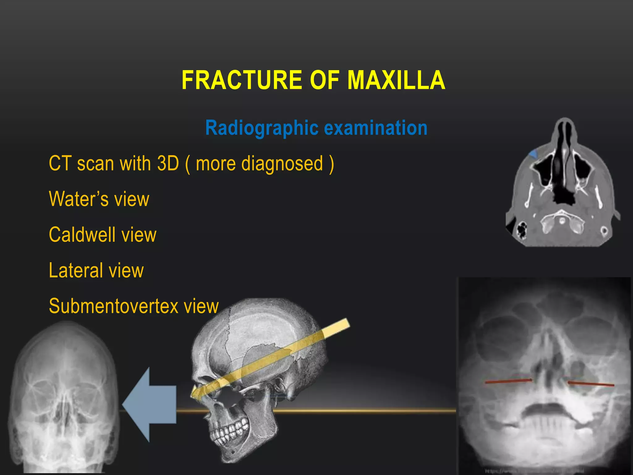 Mid facial fractures ( Mid facial trauma ) | PPTX