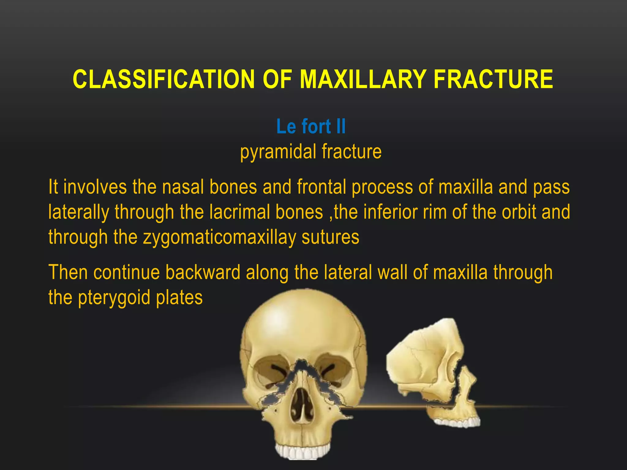 Mid facial fractures ( Mid facial trauma ) | PPTX