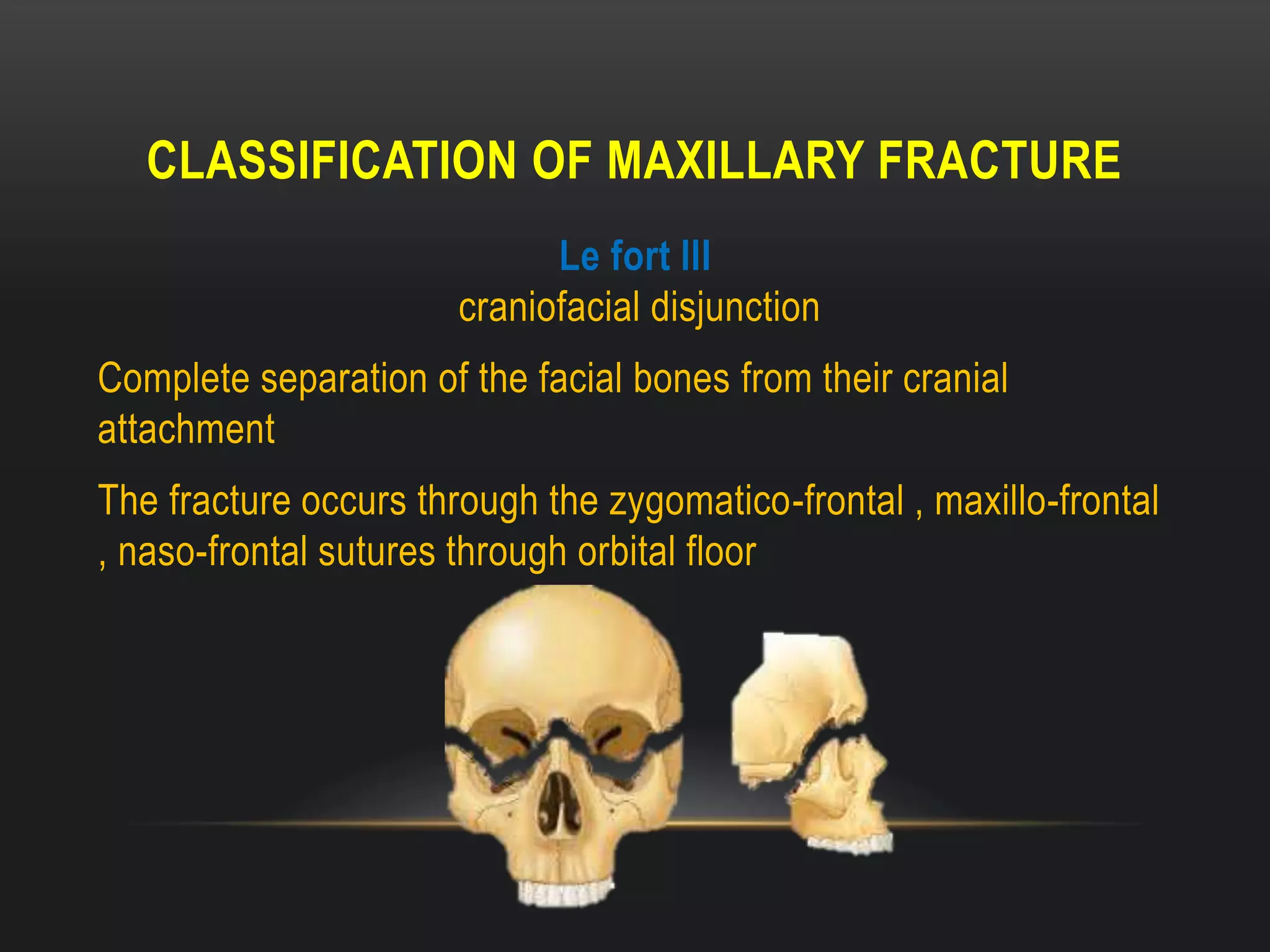 Mid facial fractures ( Mid facial trauma ) | PPTX