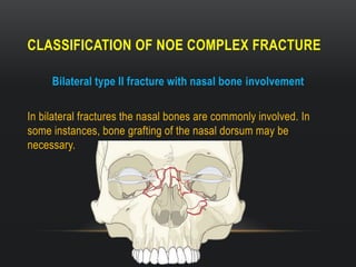 Mid facial fractures ( Mid facial trauma ) | PPTX