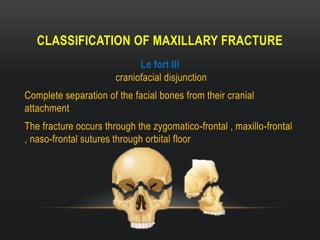 Mid facial fractures ( Mid facial trauma ) | PPTX