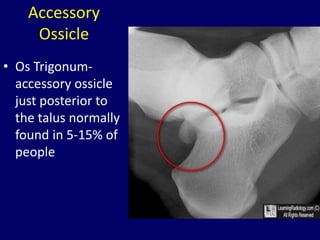 Fracture Mimics Dr. Muhammad Bin Zulfiqar | PPTX