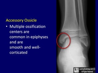 Fracture Mimics Dr. Muhammad Bin Zulfiqar | PPTX