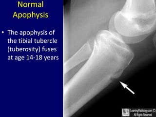 Fracture Mimics Dr. Muhammad Bin Zulfiqar | PPTX