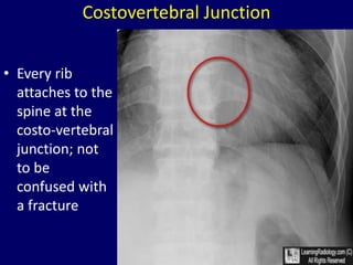 Costovertebral Junction
