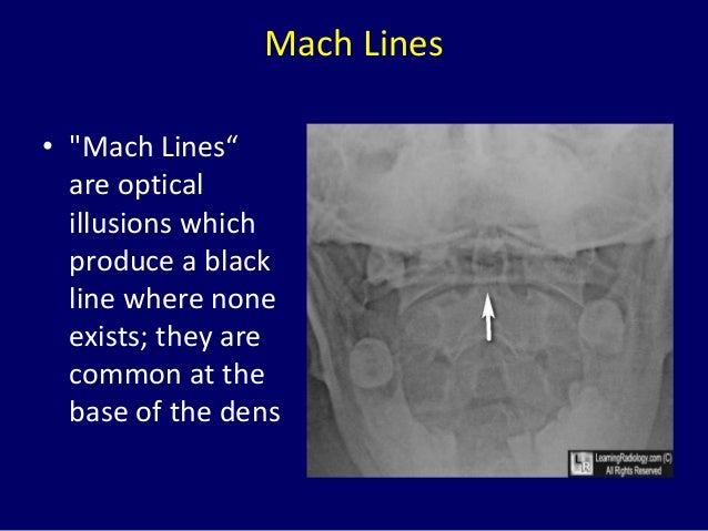 Fracture Mimics Dr. Muhammad Bin Zulfiqar