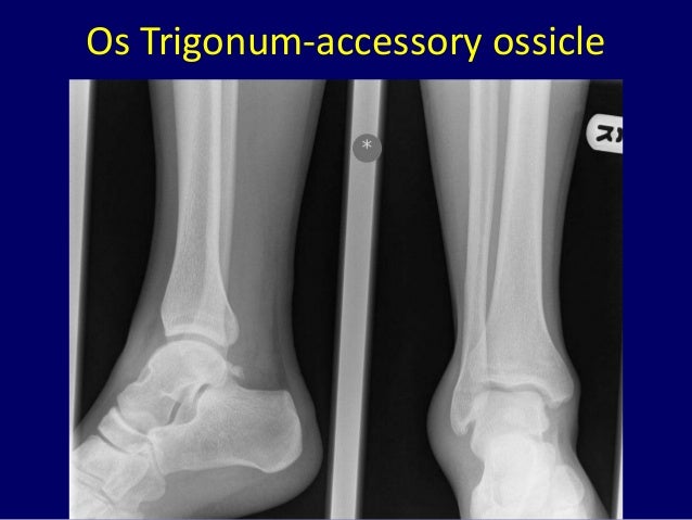 Fracture Mimics Dr. Muhammad Bin Zulfiqar