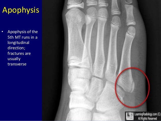 Fracture Mimics Dr. Muhammad Bin Zulfiqar