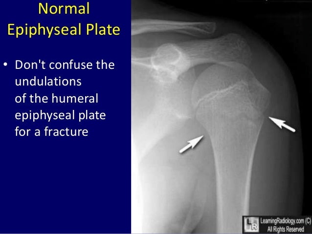 Fracture Mimics Dr. Muhammad Bin Zulfiqar