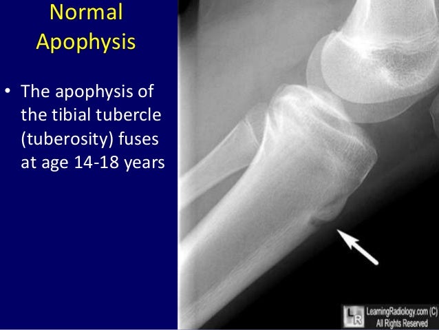 Fracture Mimics Dr. Muhammad Bin Zulfiqar