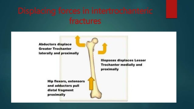 clinical anatomy of proximal femur | PPTX | Death, Injury, or Military ...