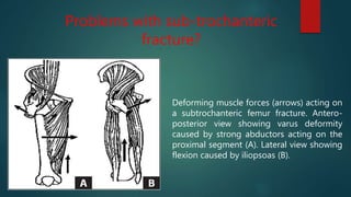 clinical anatomy of proximal femur | PPTX