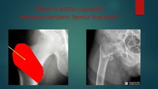 clinical anatomy of proximal femur | PPTX