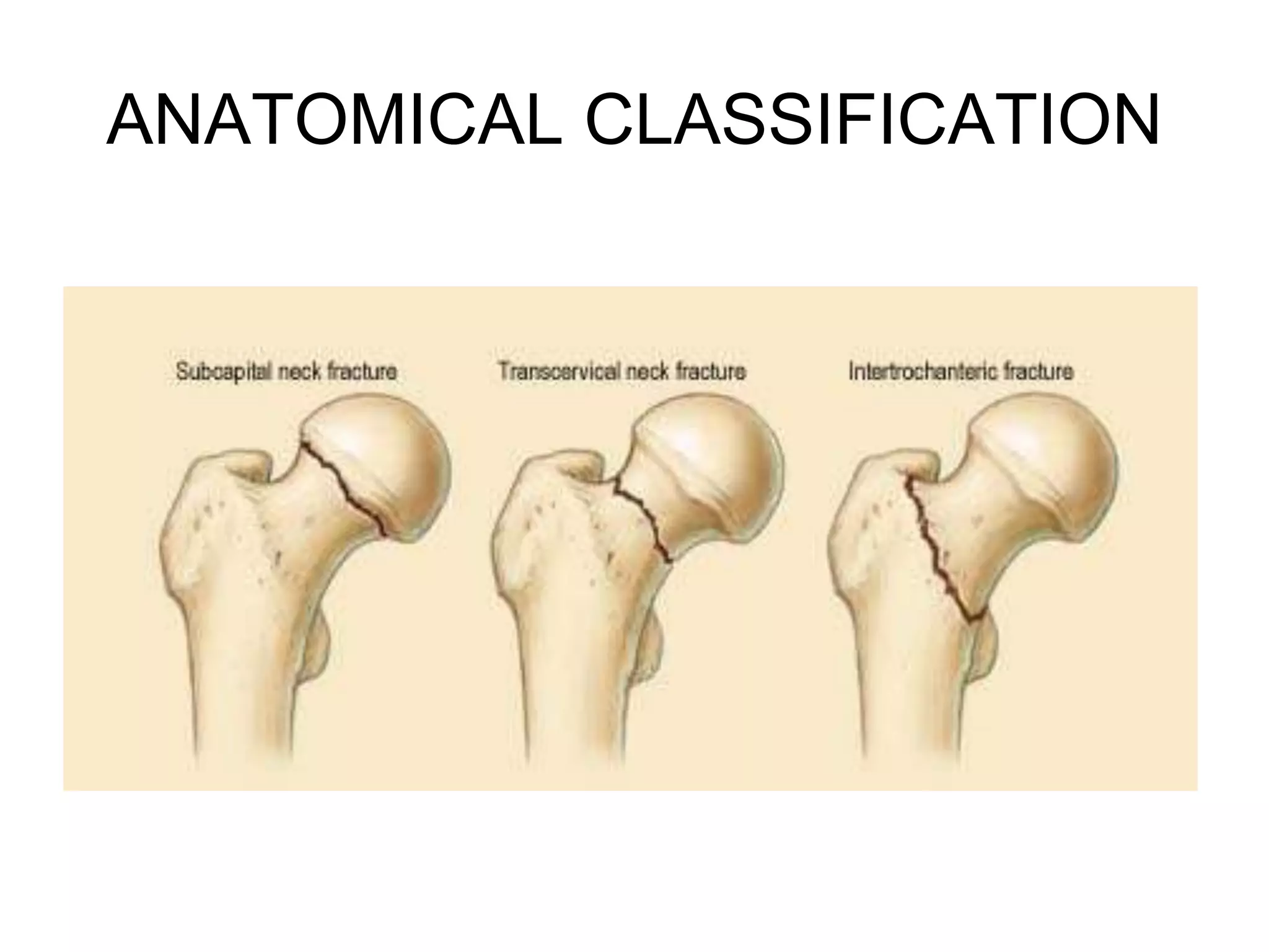 Fracture neck femur | PPT