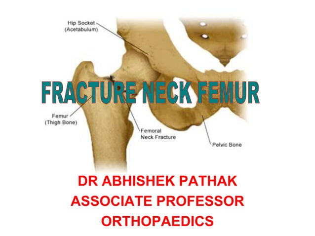Fracture neck femur | PPT