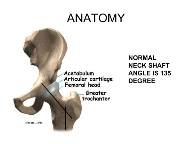 Fracture neck femur | PPT