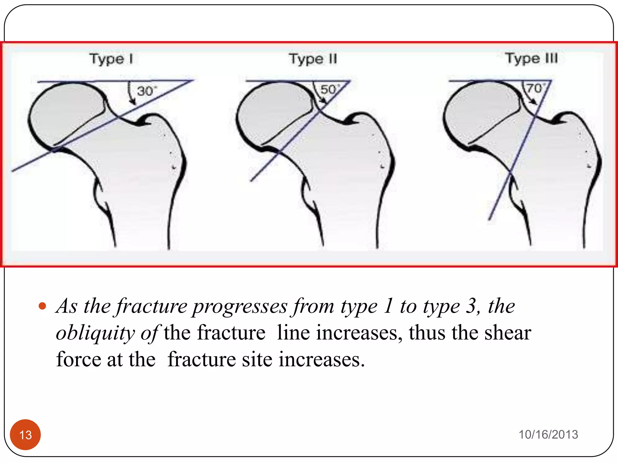 Fracture neck of femur | PPTX