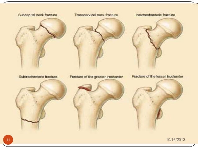 Fracture Neck Of Femur