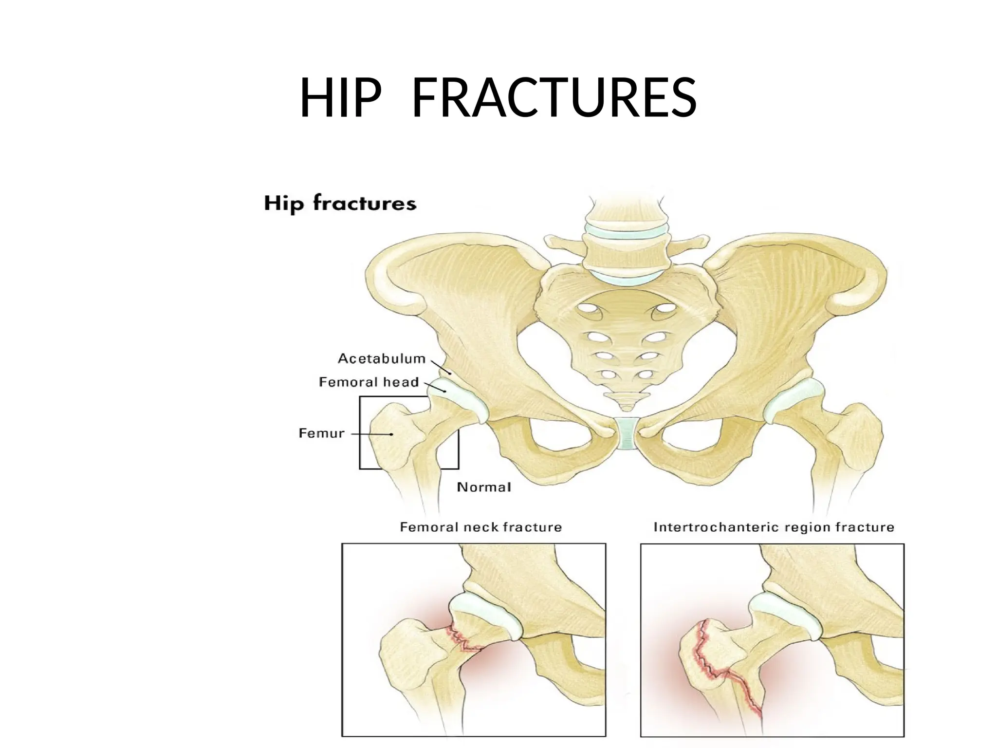 FRACTURE NECK OF FEMUR.pptx and it is a crucial lecture | PPTX