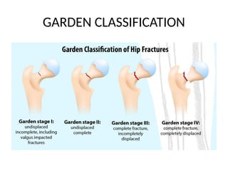 FRACTURE NECK OF FEMUR.pptx and it is a crucial lecture | PPT