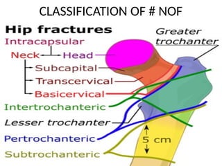 FRACTURE NECK OF FEMUR.pptx and it is a crucial lecture | PPTX