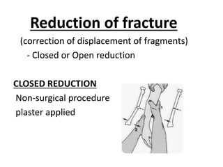 FRACTURE new.pptx