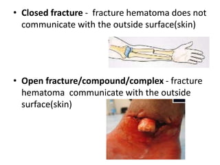 FRACTURE new.pptx