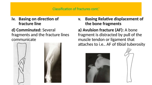 Fracture , causes, classification & managemeny | PPTX