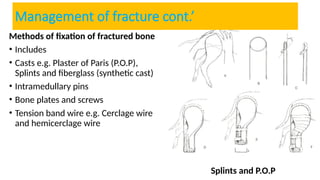 Fracture , causes, classification & managemeny | PPTX