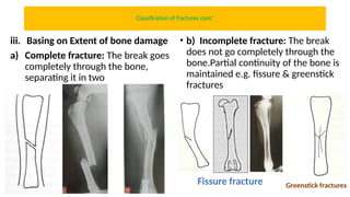 Fracture , causes, classification & managemeny | PPTX