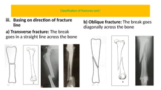 Fracture , causes, classification & managemeny | PPTX