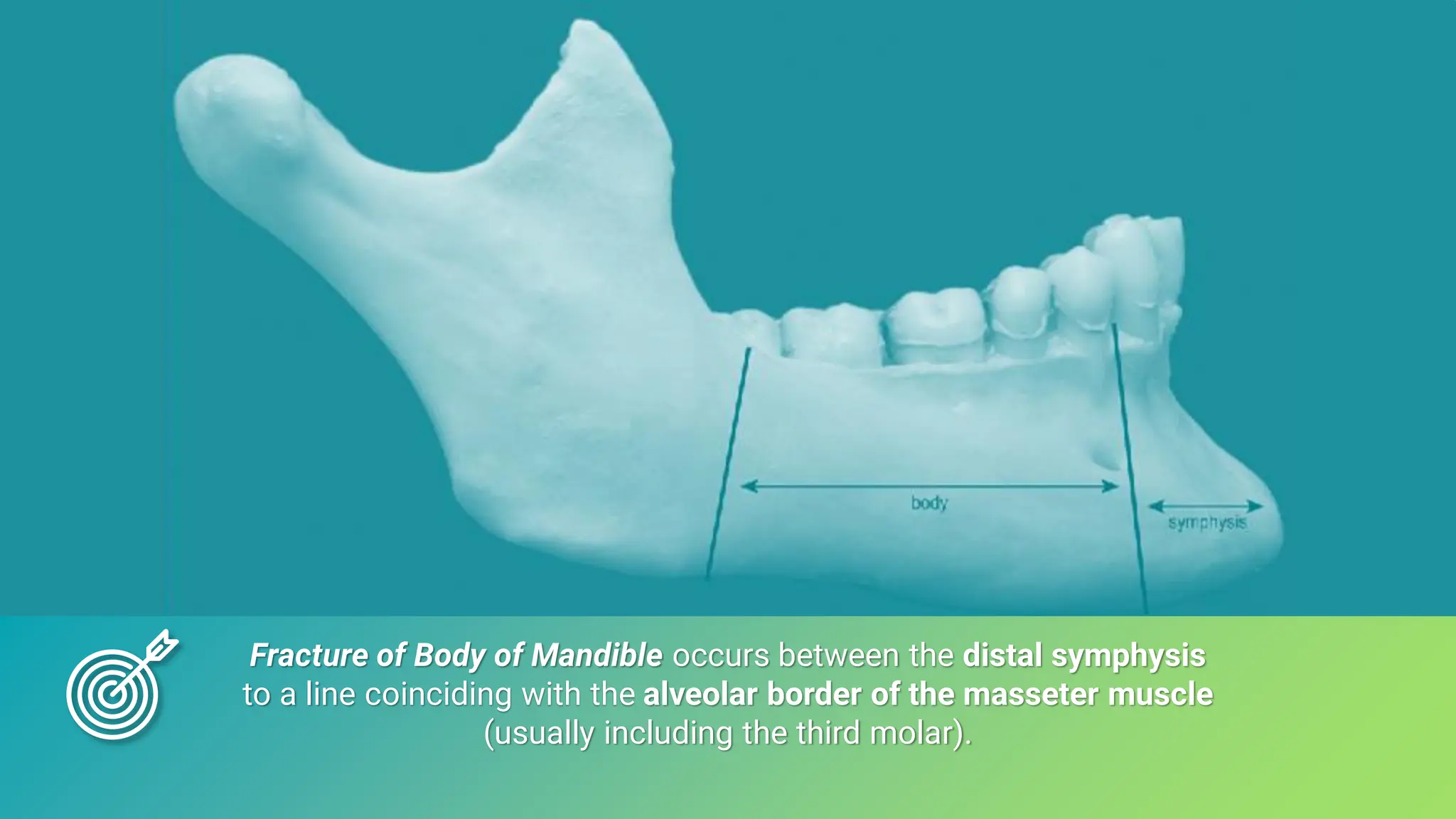 Fractures of The Body of The Mandible In Maxillofacial Surgery | PDF