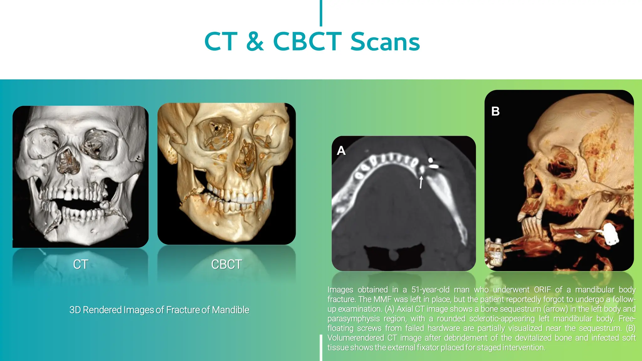 Fractures of The Body of The Mandible In Maxillofacial Surgery | PDF