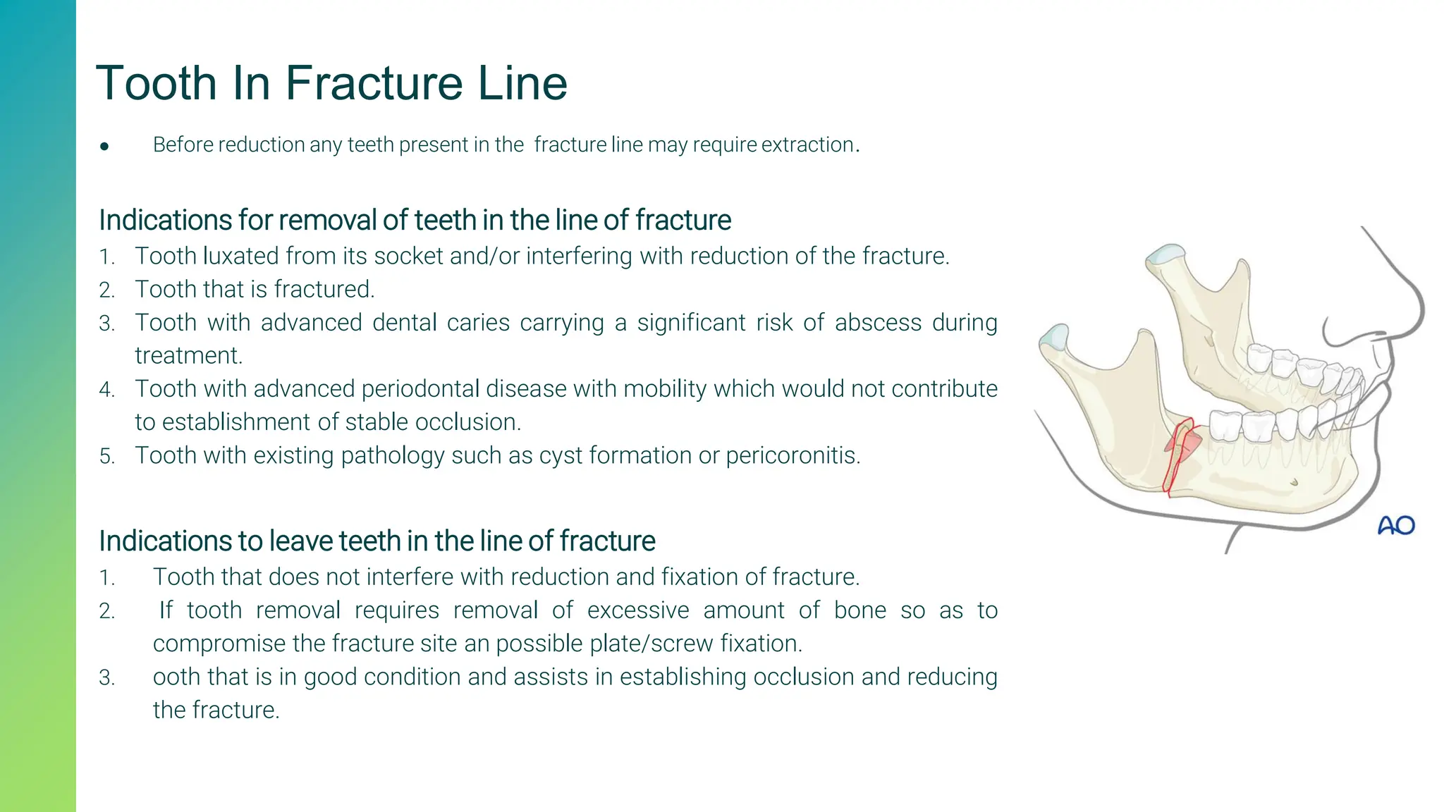 Fractures of The Body of The Mandible In Maxillofacial Surgery | PPT