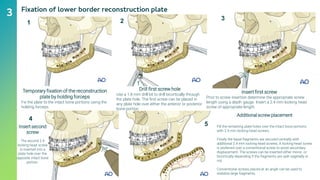 Fractures of The Body of The Mandible In Maxillofacial Surgery | PPT
