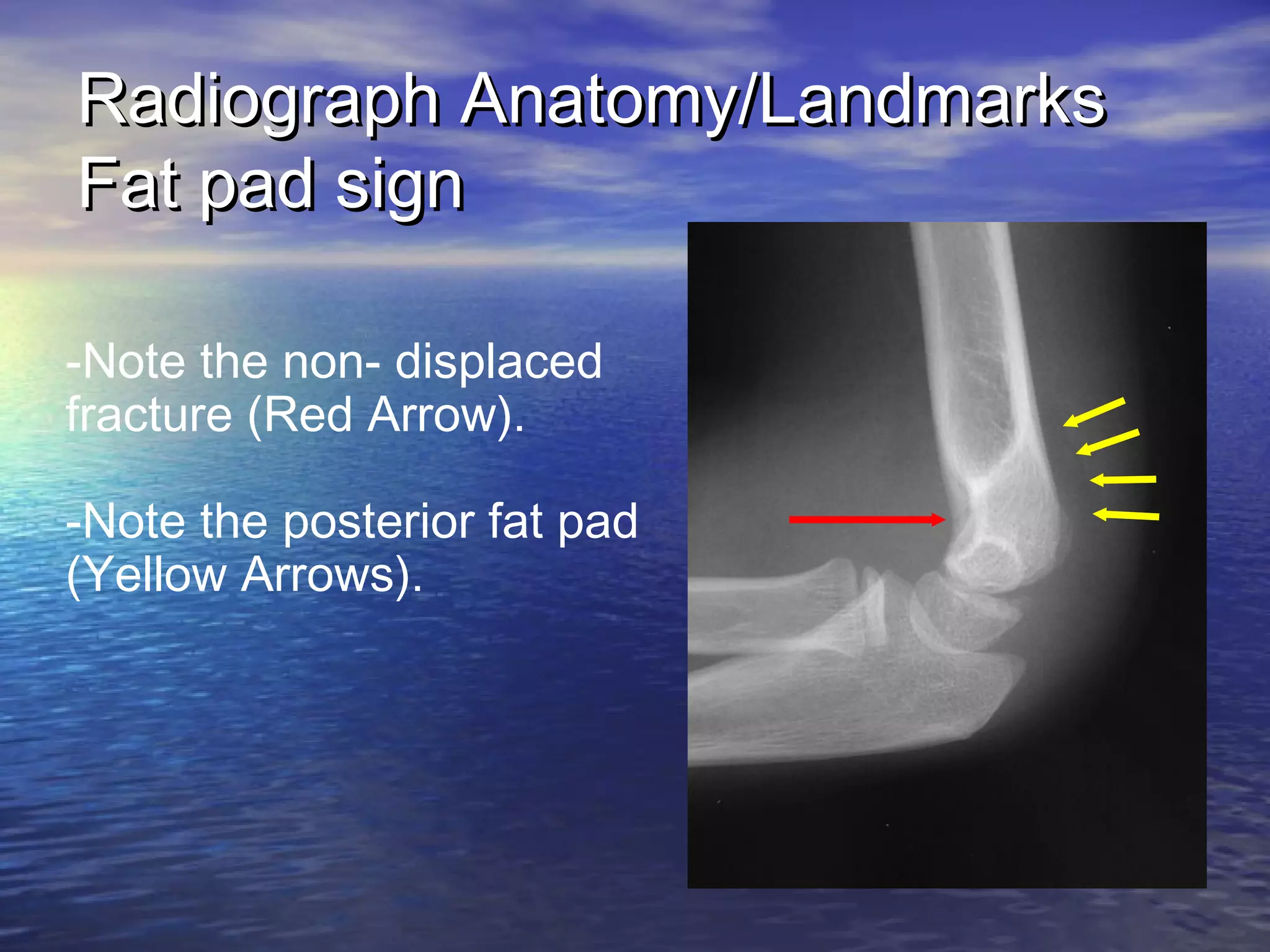 Fracture of Distal End Humerus. | PPT