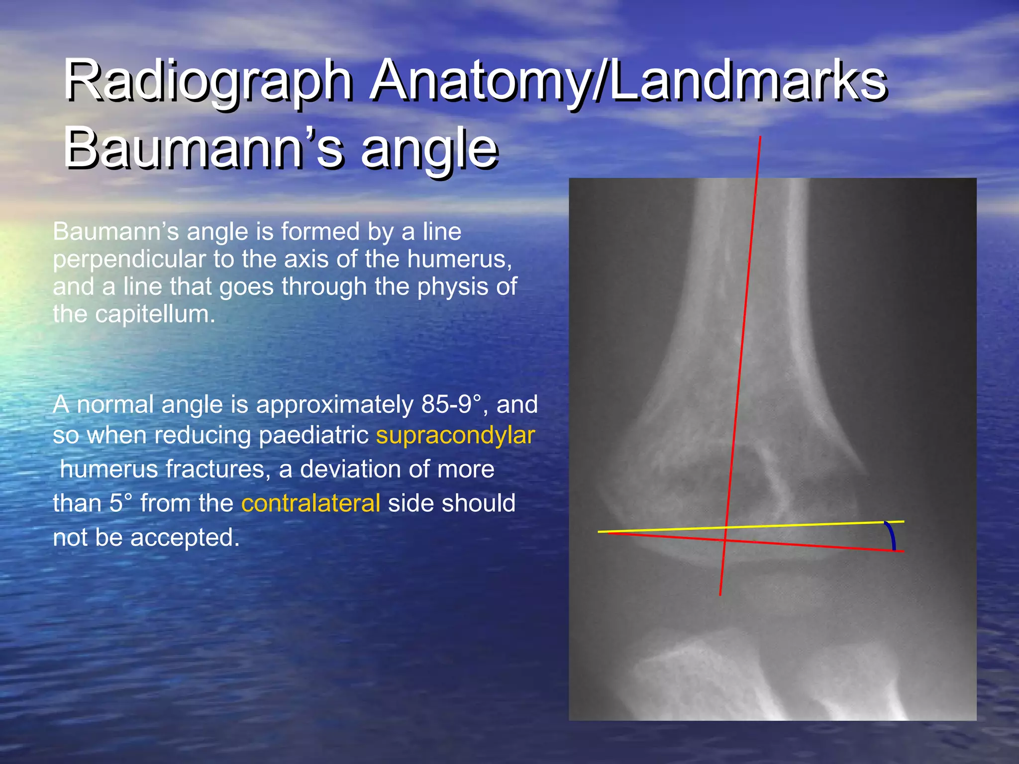 Fracture of Distal End Humerus. | PPT