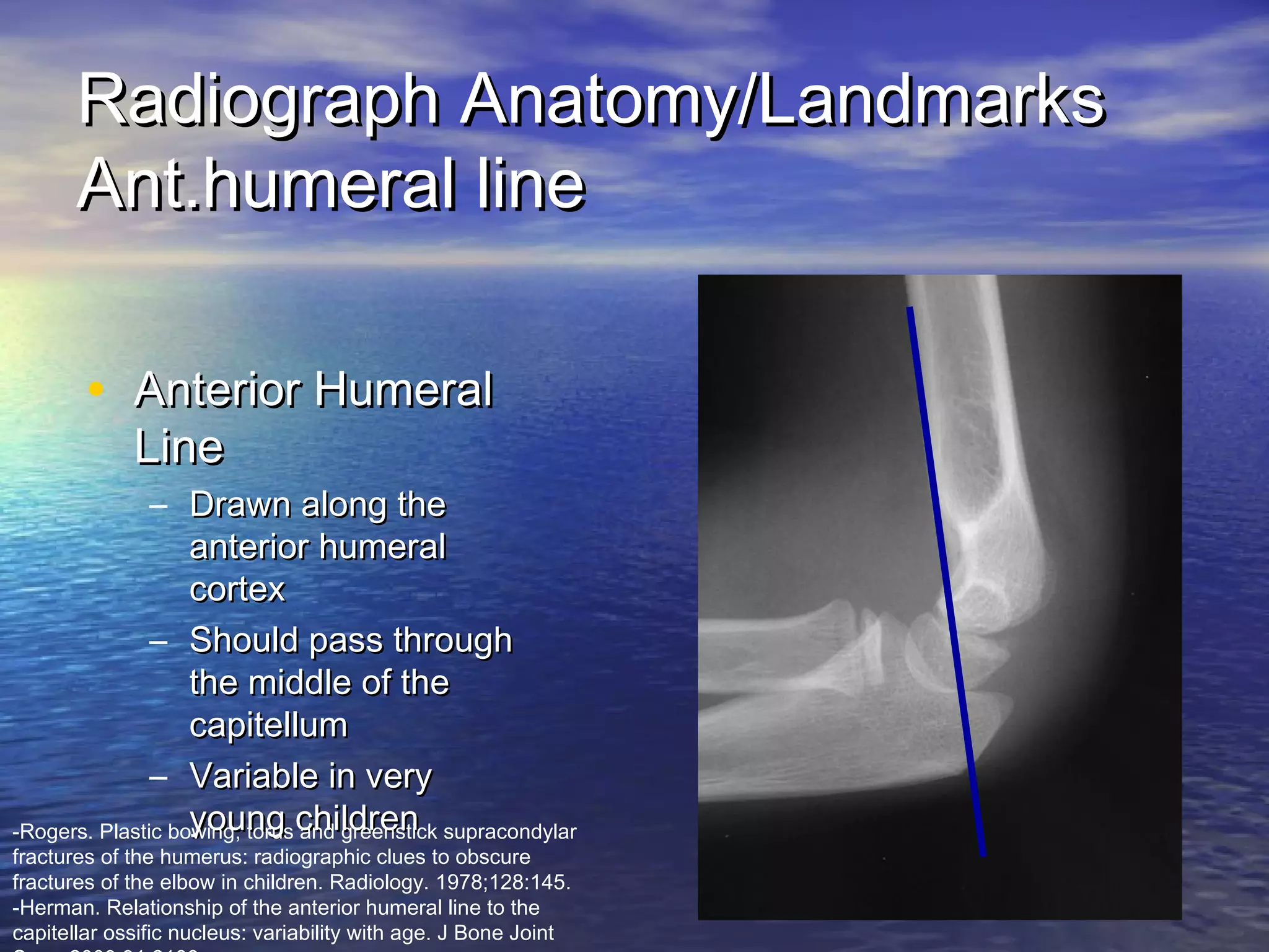 Fracture of Distal End Humerus. | PPT