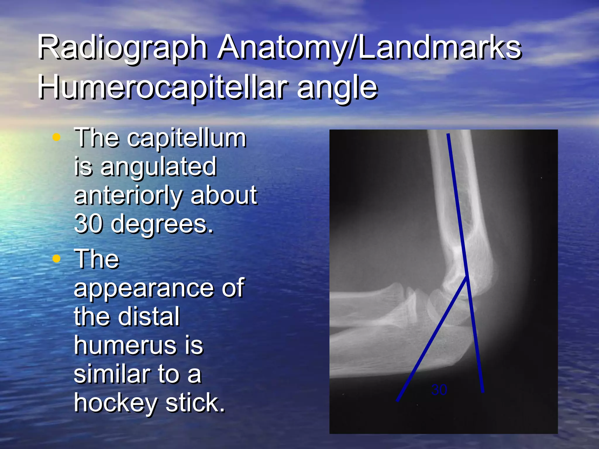 Fracture of Distal End Humerus. | PPT