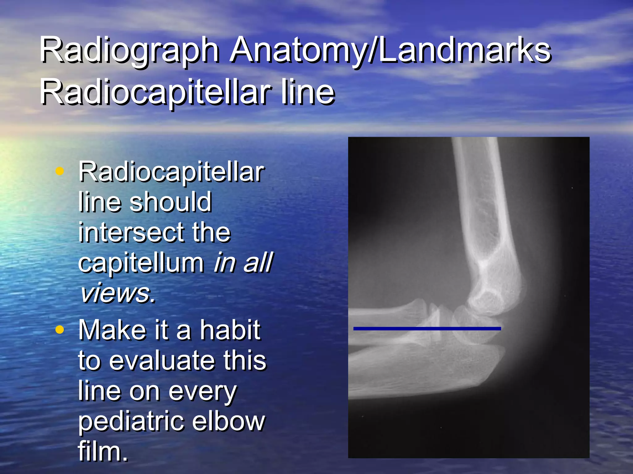 Fracture of Distal End Humerus. | PPT