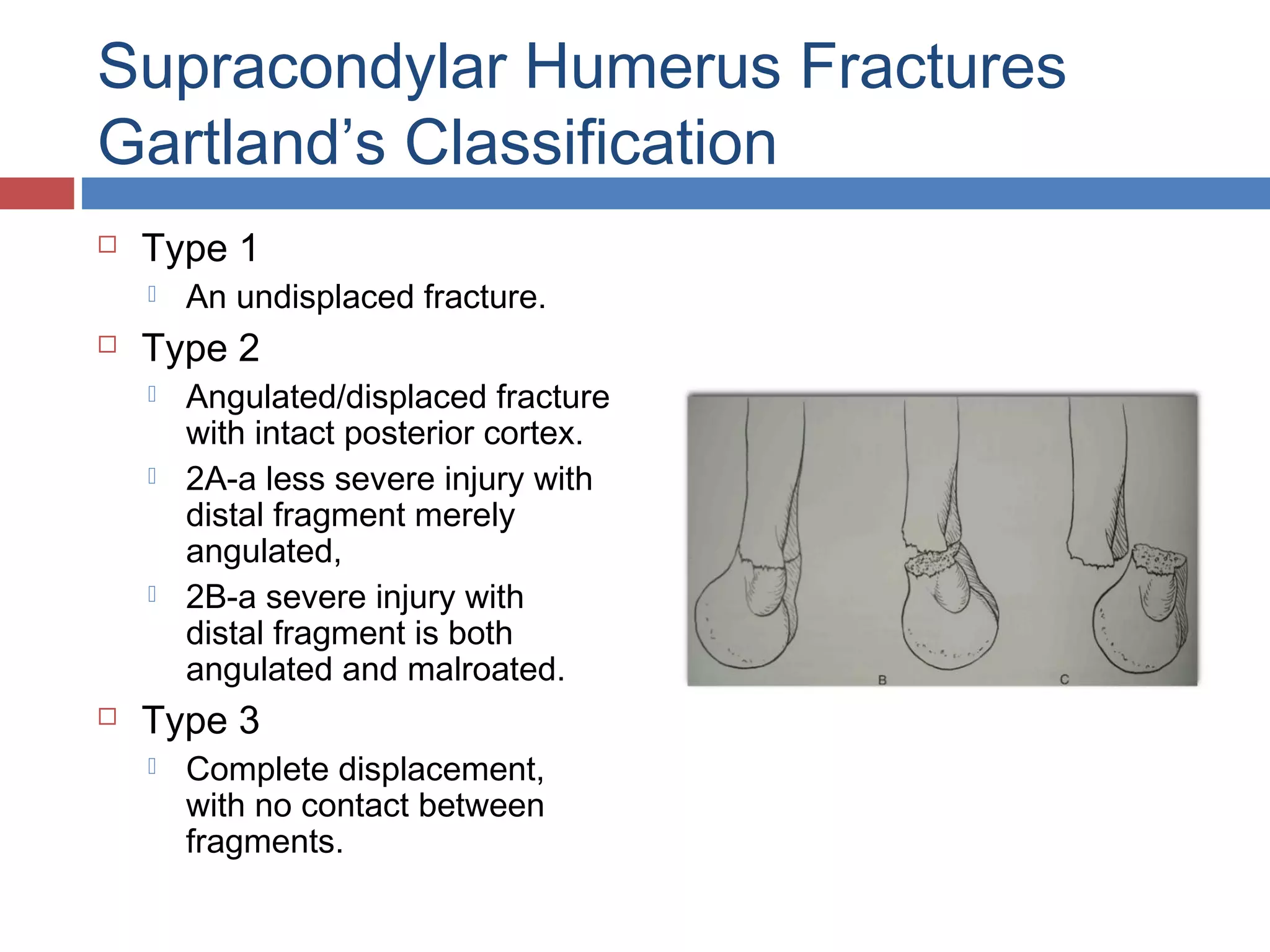 Fracture of Distal End Humerus. | PPT