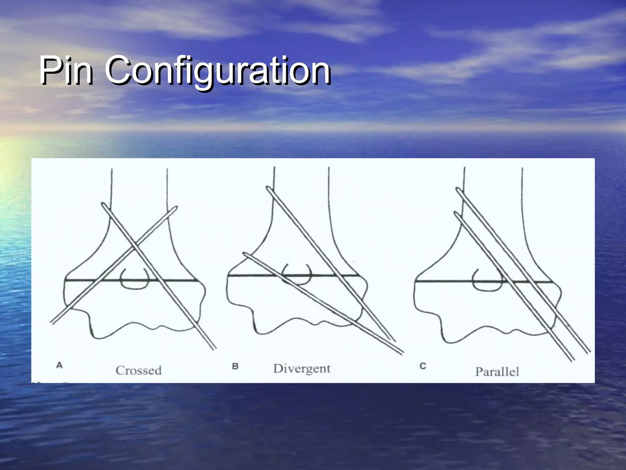 Fracture of Distal End Humerus. | PPT