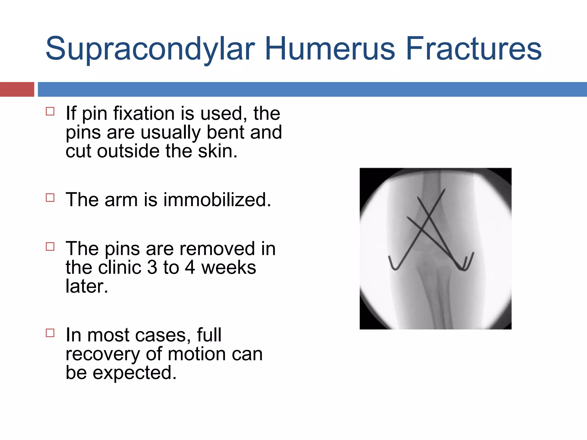 Fracture of Distal End Humerus. | PPT